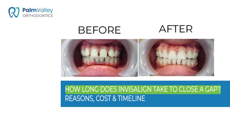 How Long Does Invisalign Take to Close a Gap? Reasons, Cost & Timeline
